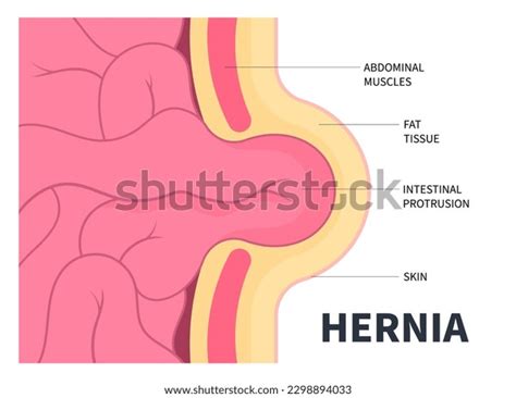 Cross Section Anatomy Bowel Hernia That Stock Vector Royalty Free