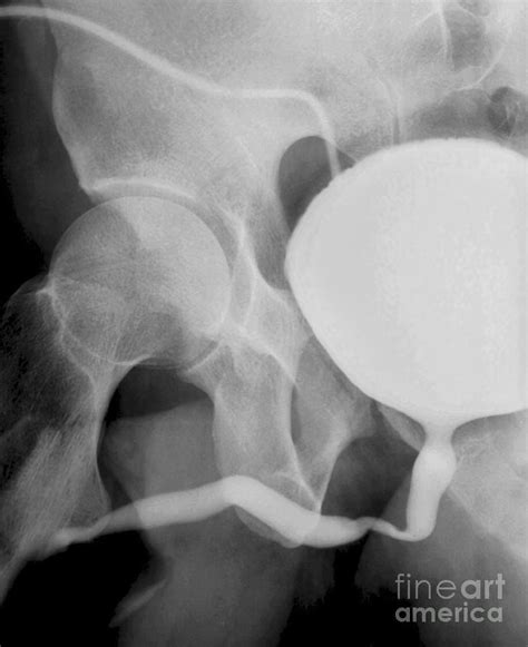 Voiding Cystourethrogram X Rays Photograph By Zephyr Pixels