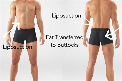 Buttsculpt™ For Men Male Bbl Brazilian Butt Lift Xsculpt™