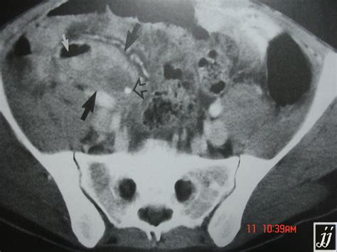 Appendix Abscess Referenced Image Radiopaedia