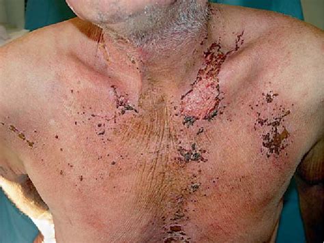 Figure 1 From Persistent Erythema Multiforme In A Patient With Extrahepatic Cholangiocarcinoma