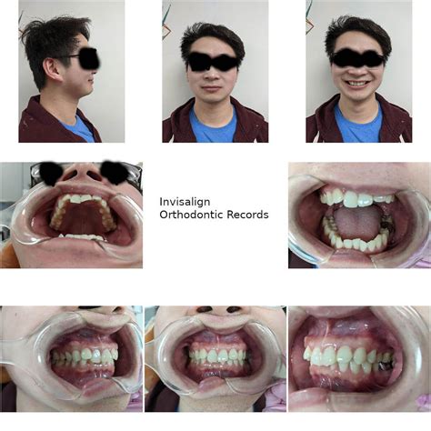 Invisalign Process Step By Step From Start To Finish 1311 Jackson Ave Dental Dentist In