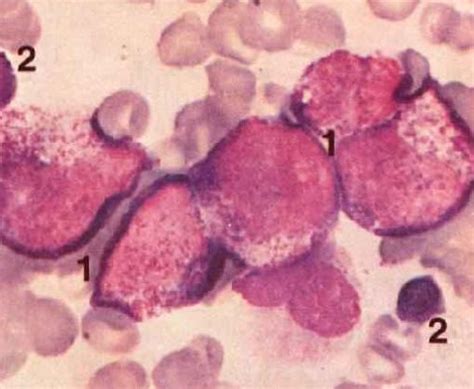 成熟障碍型粒细胞缺乏症骨髓象中医血液病网