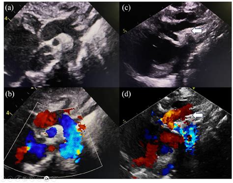 Suprasternal Echocardiogram In Normal Control A And B The