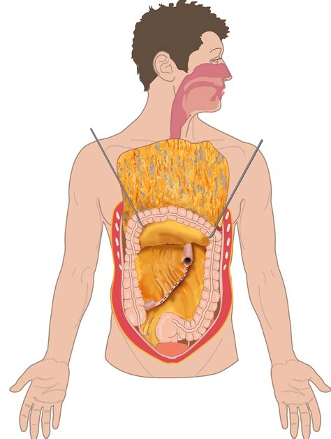 Slagter Drawing Opened Abdomen Jejunum And Ileum Removed No Labels