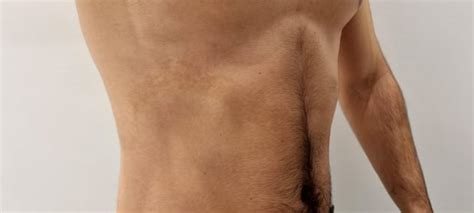 Hyperpigmented Lesion Rdermatologyquestions