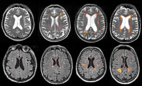 Unnoticed Lesions In The Brain Slow Down Thinking