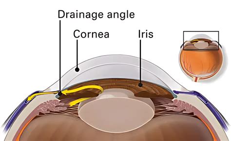 Understanding Different Types Of Glaucoma Glaucoma Australia