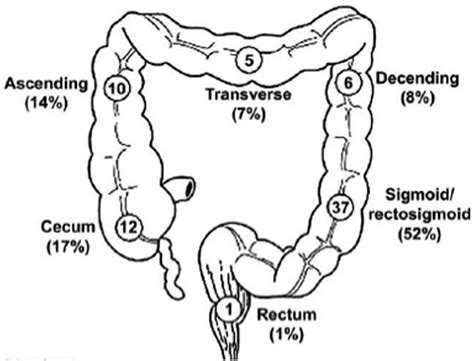 Colonoscopic Perforations Pmc