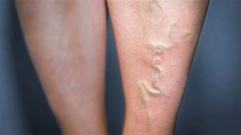 Phlebitis In Lima Celina Ohio Vein Care Center