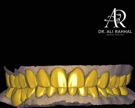 Dr Ali Rahhal On Linkedin Exocad Modeling Full Mouth Rehabilitation