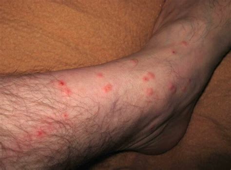 Top 10 Gnat Bites Pictures Explained Pest Professional Services