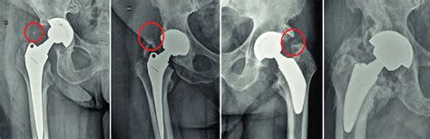 Brooker Classification Of Heterotopic Ossifications Ho A Grade I