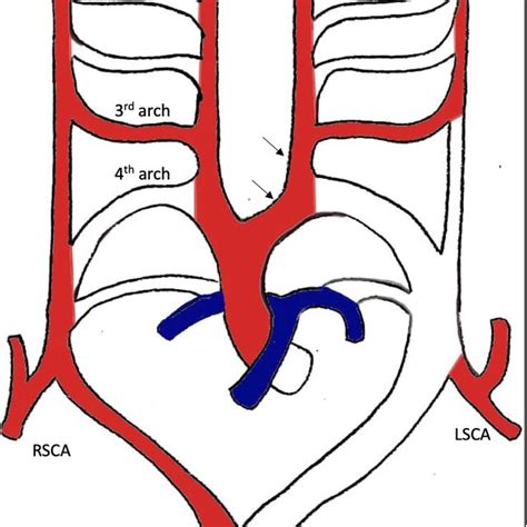 Origin Of The Left Common Carotid Artery From Ascending Aorta In