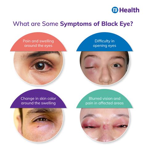 A Complete Guide On Black Eye How To Know If You Have It