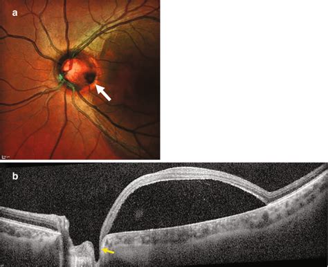 Optic Pit Maculopathy Springer Nature Link