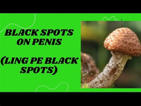 लिंग पे काले दाने । Black Spots On Penis Melanosis Youtube