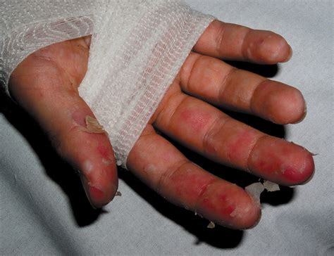 Can A Rat Bite A Human At Lachlan Ricardo Blog