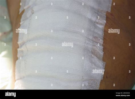 The Surgical Suture Is Covered With A Gauze Dressing Total Knee Joint Replacement Close Up
