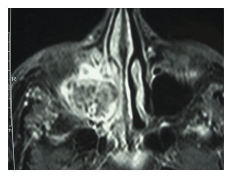 Magnetic Resonance Of The Maxillary Sinus Mass Download Scientific
