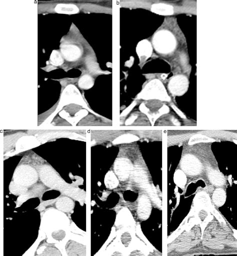 Normal Ct Characteristics Of The Thymus In Adults Semantic Scholar