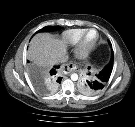 Computed Tomography Demonstrating Pneumomediastinum And A Mild
