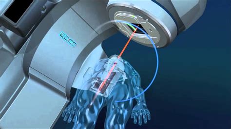 Edge With Hyperarc New Age In Intracranial Frameless Stereotactic