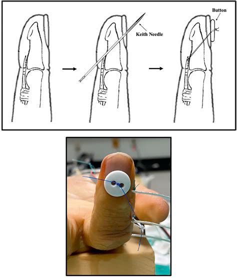 The Evaluation Of A Flexor Digitorum Profundus To Volar Plate Zone I