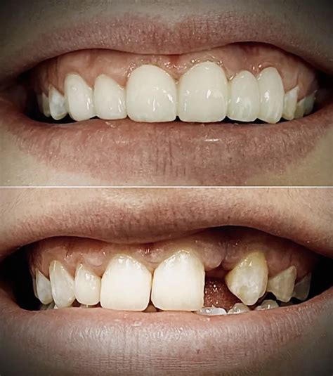 Broken Tooth Smile Essentials Dental Care