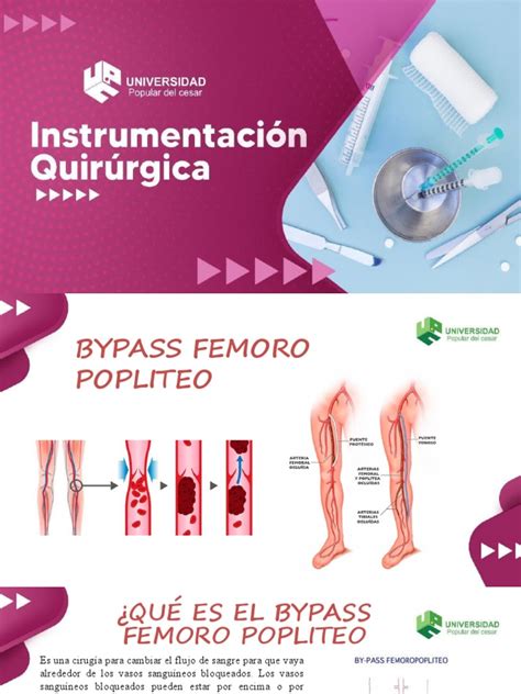 Bypass Femoro Popliteo Pdf Cirugía De Bypass De La Arteria