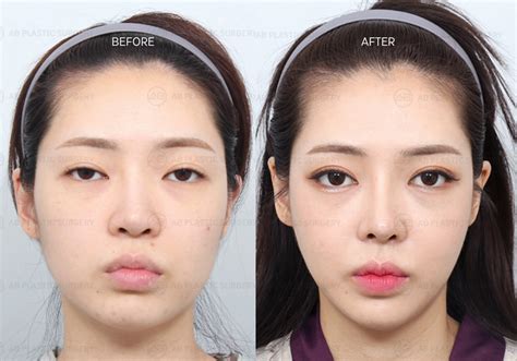Full Body Korean Plastic Surgery Before And After Reddit