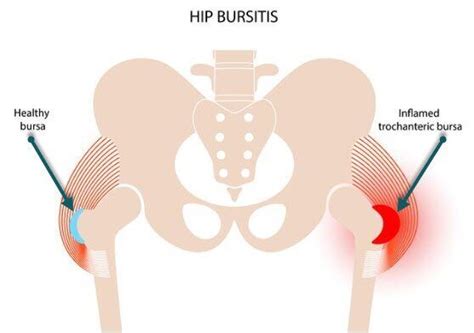 Tips To Prevent And Treat Hip Bursitis For Runners Marathoners
