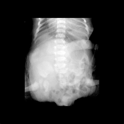 Newborn With Anterior Abdominal Wall Defect Pediatric Radiology Case