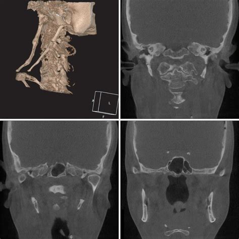 Cone Beam Computed Tomography Shows That Both Calcified Stylohyoid