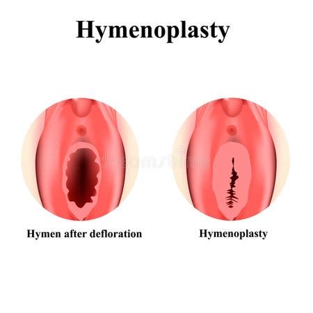 The Structure Of The Vulva Hymen Hymenoplasty Hymen After Defloration