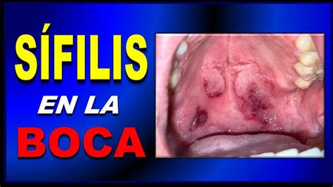 SÍfilis En La Boca Síntomas Y Lesiones Que Debes Conocer Youtube