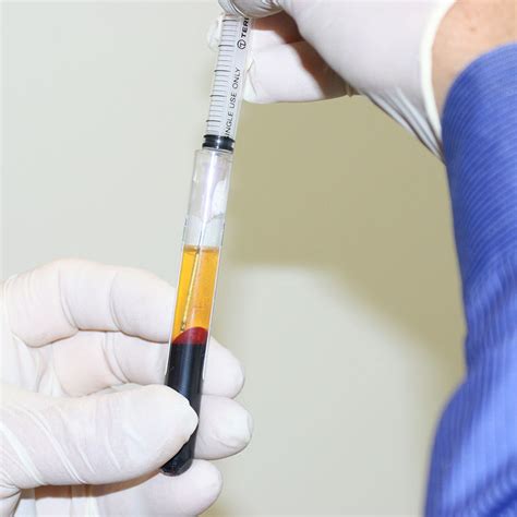 How Prp Injections Work Simple Guide To Platelet Rich Plasma Therapy