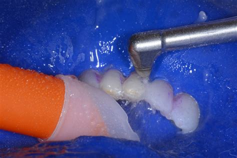 Bioclear Blaster Efficient Biofilm Removal Bioclear