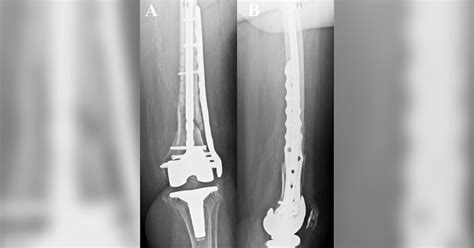 82 Year Old Woman With A Periprosthetic Distal Femur Fracture