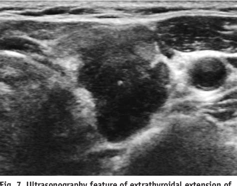 Figure 7 From 2021 Korean Thyroid Imaging Reporting And Data System And