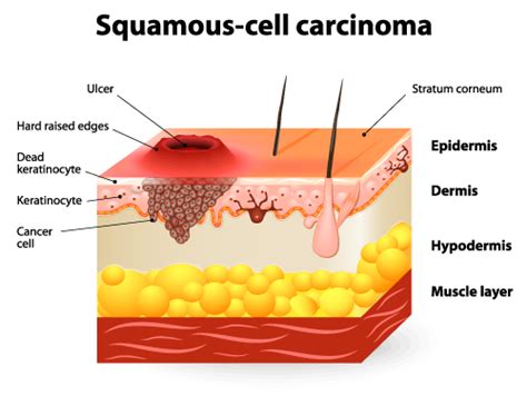 Squamous Cell Carcinoma Silent Killer
