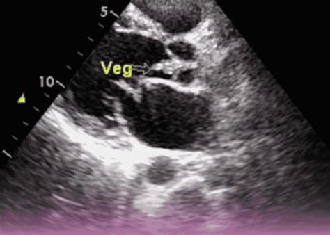 Septic Shock And Infective Endocarditis