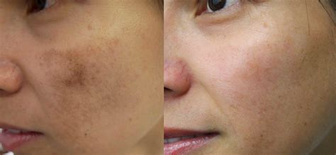 Pih Laser And Topicals Cutis Clinic