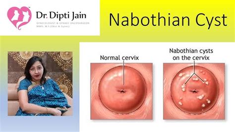 Nabothian Cyst In Cervix Causes Symptoms Nabothian Cyst Treatment
