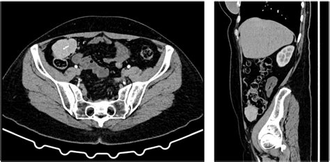 4 2 × 4 6 × 4 6 Cm Solid Lesion Located In The Antimesenteric Border Of