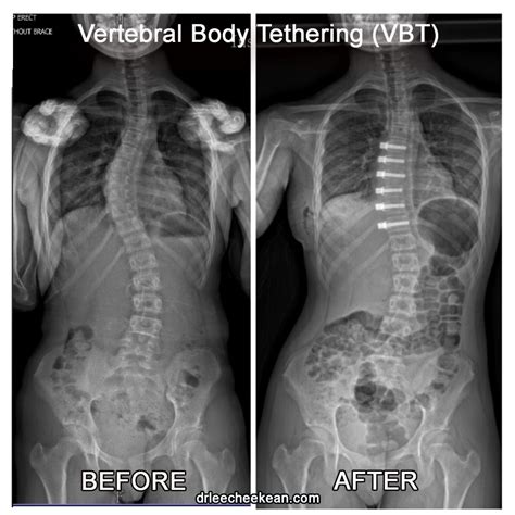Malaysia First Vertebral Body Tethering Vbt Surgery For Scoliosis