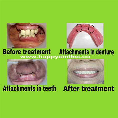 Tooth Supported Overdenture Happy Smiles