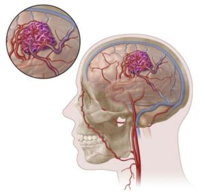 Arteriovenous Malformation Neurosurgery Located In Fort Worth