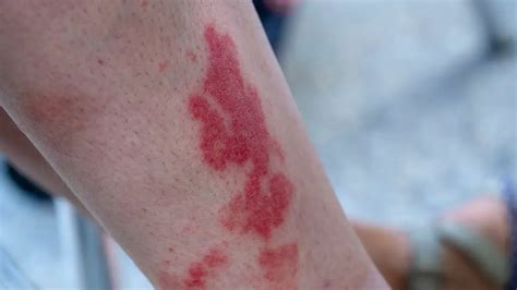 40 Facts About Leukocytoclastic Angiitis