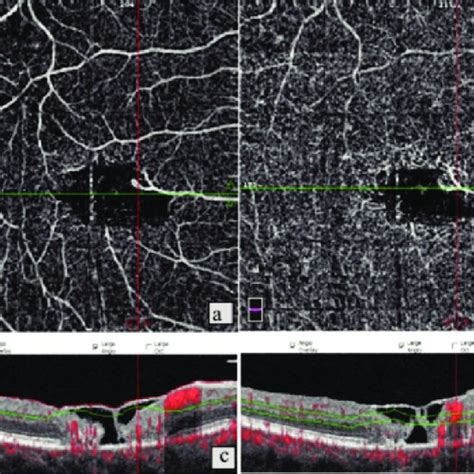 Patient 1 Right Eye A Superficial Capillary Plexus Appears Normal On Download Scientific